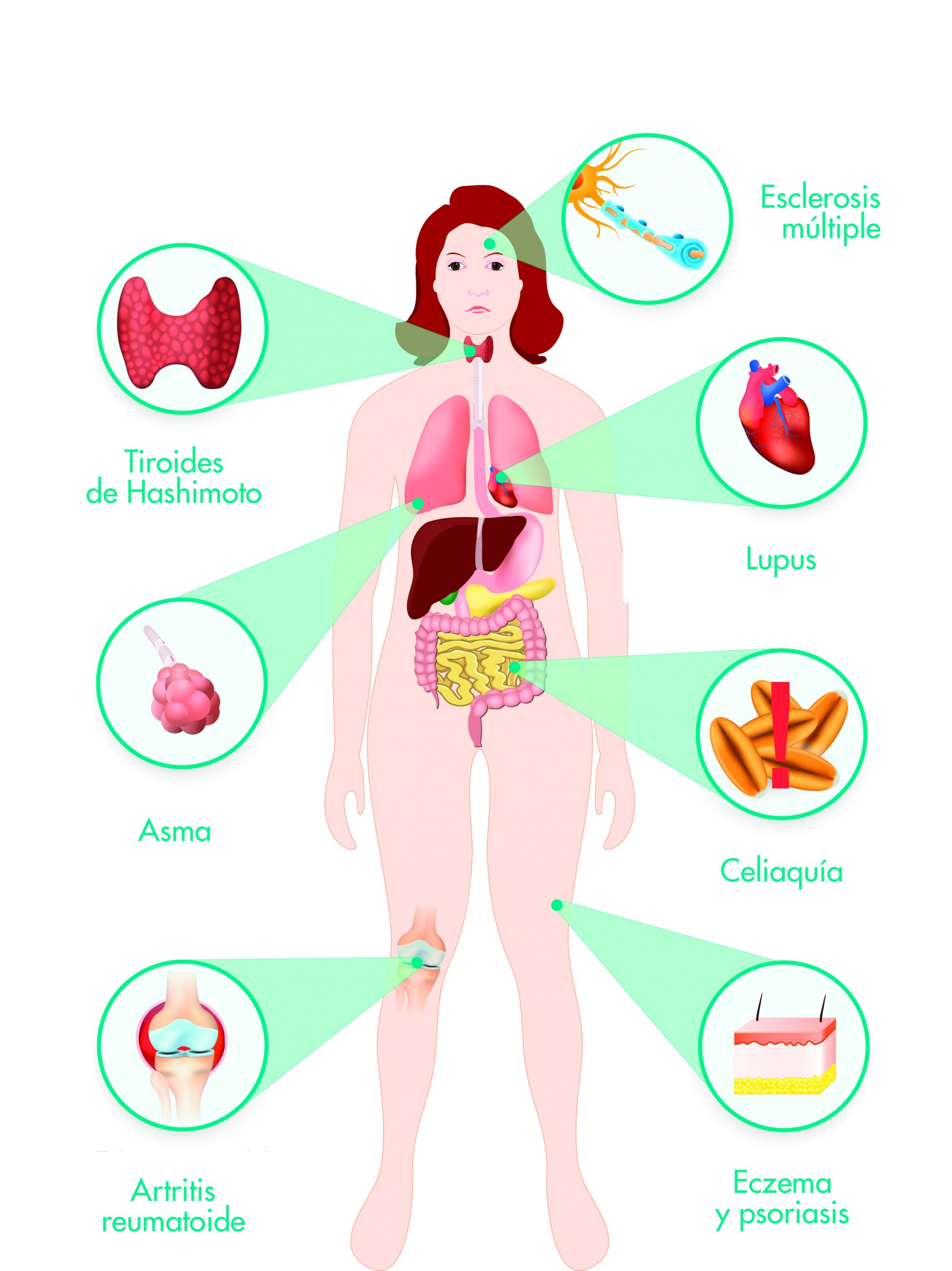 ENFERMEDADES AUTOINMUNES – nutrEATude